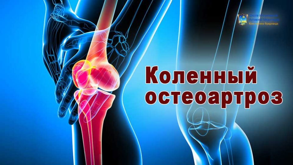 О коленном остеоартрозе